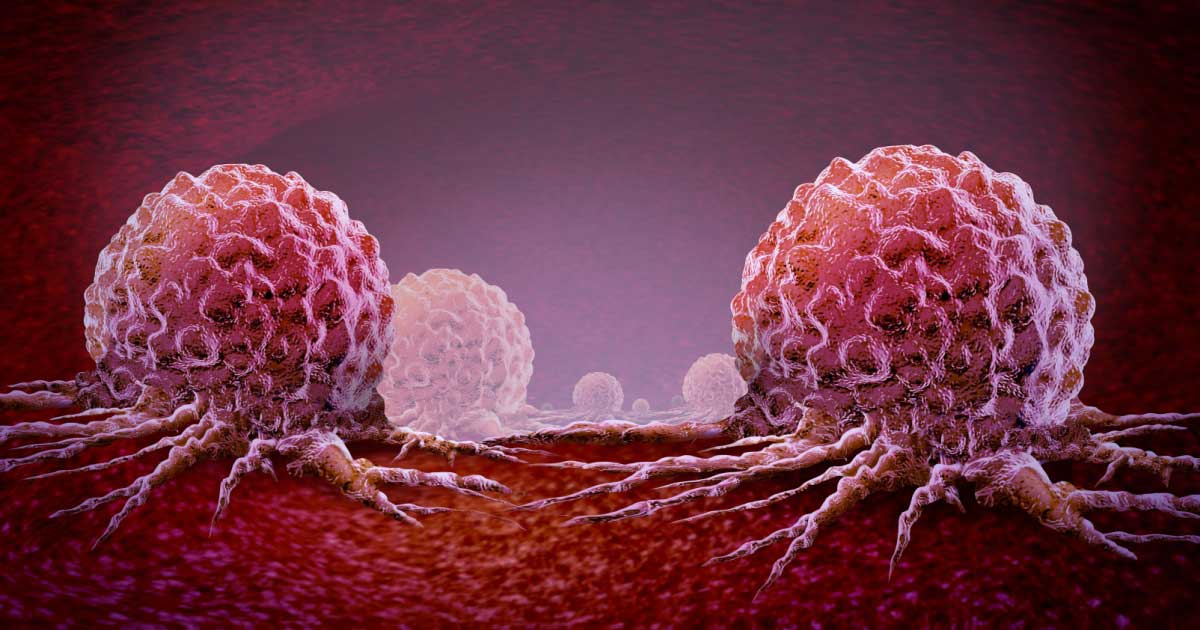 7 Early Signs of Breast Cancer