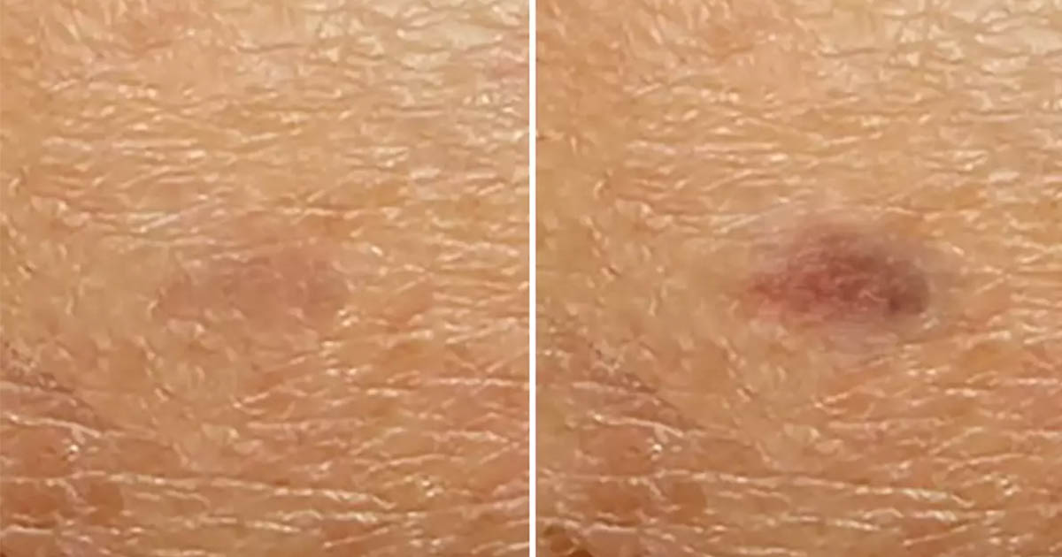 Video Time-Lapse Shows How Dark Patch of Skin Turns Into Melanoma Cancer