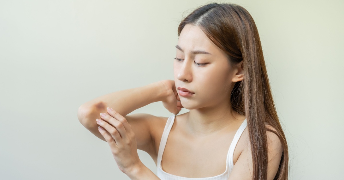 10 Reasons Why You’re Bruising Easily