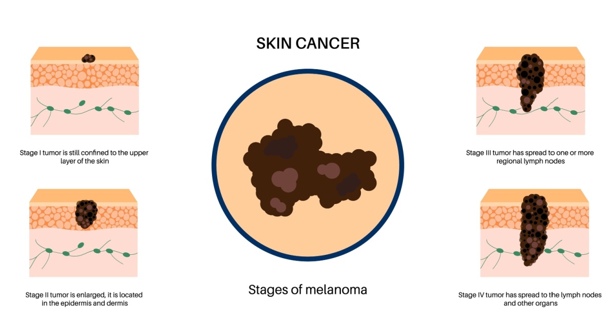 5 Signs of Melanoma to Look Out For