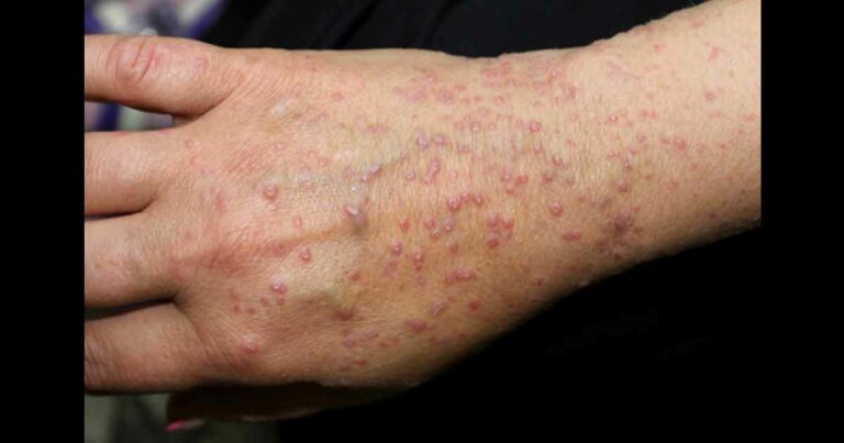 11 Reasons Why You Have Red Dots On Your Skin