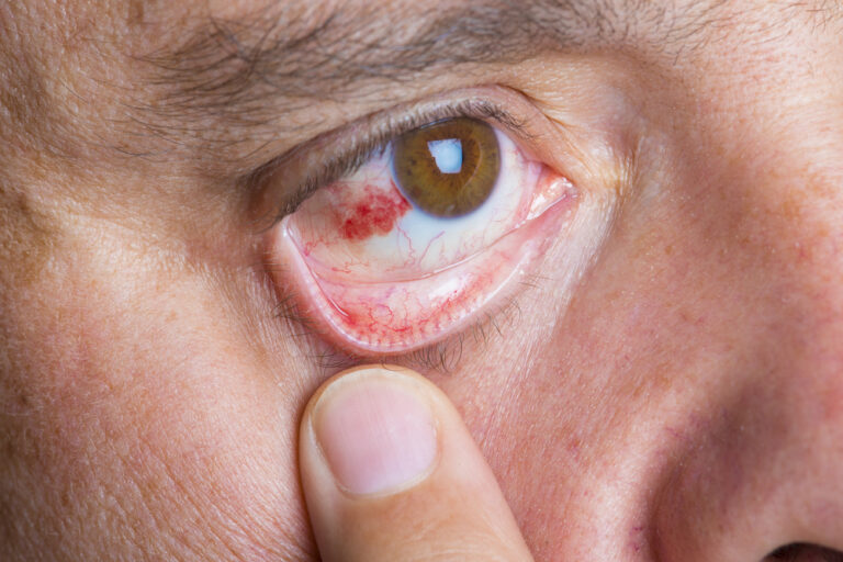 Causes of Pain Behind Your Eyes & How to Make it Stop