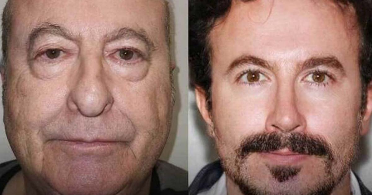 Man Receives Facial Surgery in Turkey, and People Can’t Believe ...