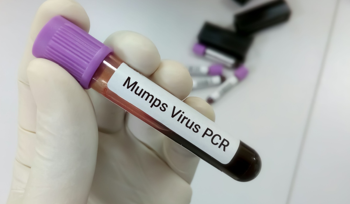 Parotitis: Signs, Symptoms, and Treatment