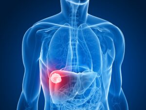 Bruise easily? Itchy skin? 5 signs you have liver damage without even ...