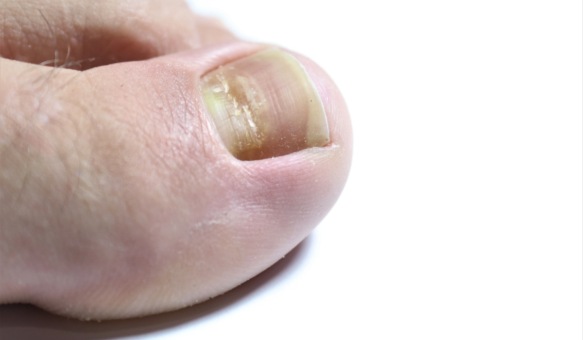 Doctor Reveals 7 Health Conditions You Can Spot By Just Checking Your Nails