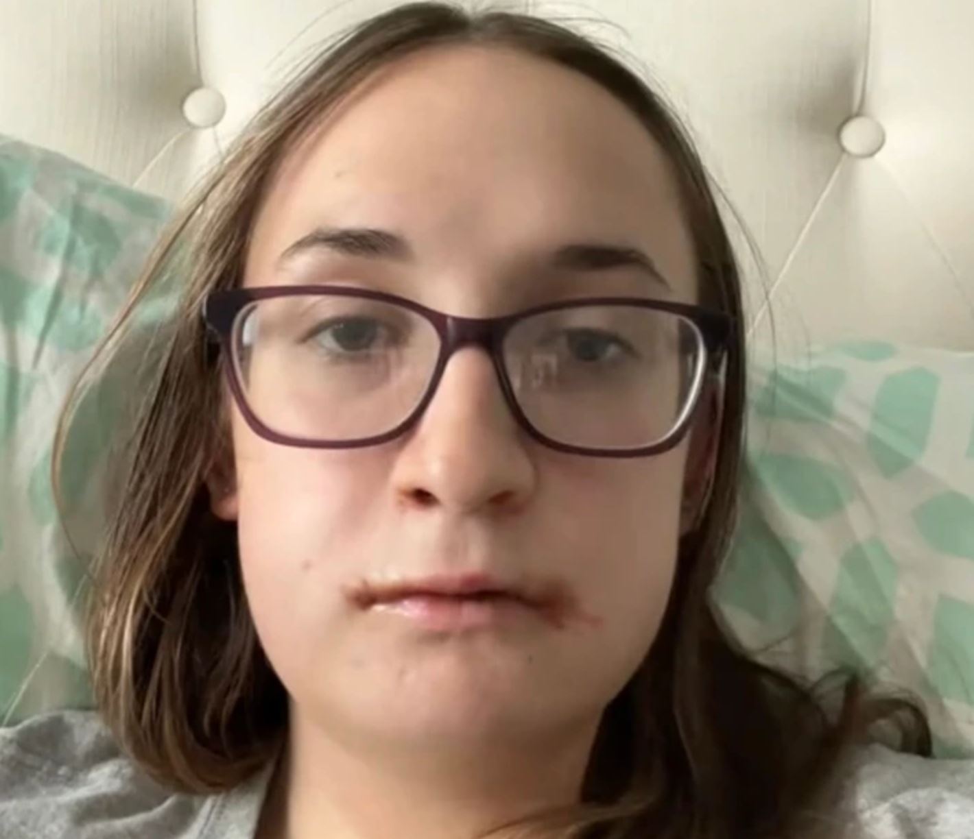 Young Woman Goes Viral After Revealing Stunning Results of Her Jaw Surgery