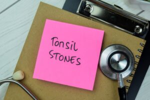 Here’s What You Need to Know About Tonsil Stones
