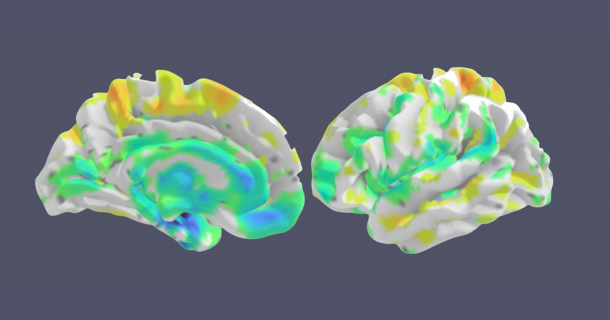 Scientists Name New Type of Memory Loss Often Mistaken For Alzheimer's ...