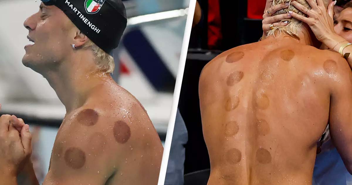 Olympians Spotted With ‘Cupping’ Marks On Their Bodies. Does It Work ...