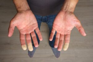 Doctor Shares Eleven Subtle Signs on Your Hands That Can Indicate ...