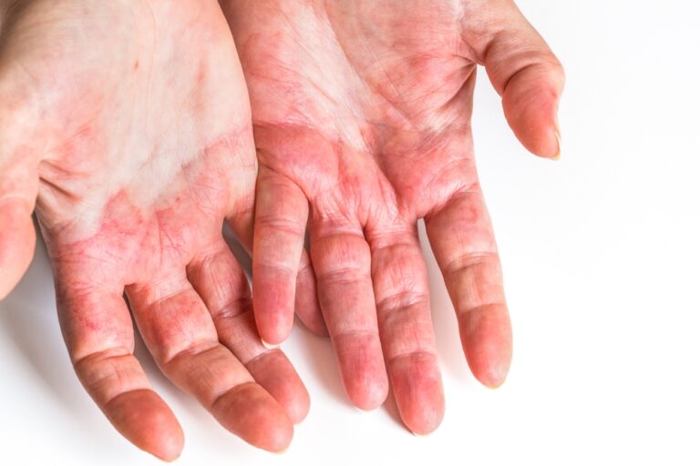 Doctor Shares Eleven Subtle Signs on Your Hands That Can Indicate ...