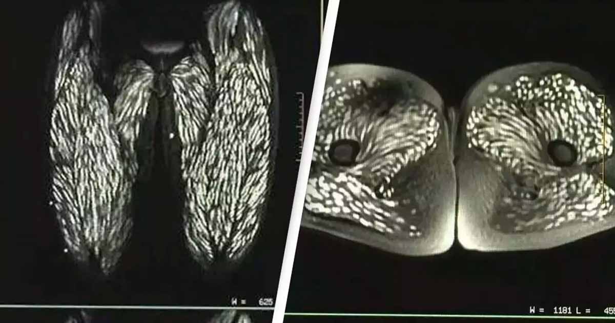 Scans Reveal Parasite-Infested Body of Woman Who Ate Large Amounts of ...