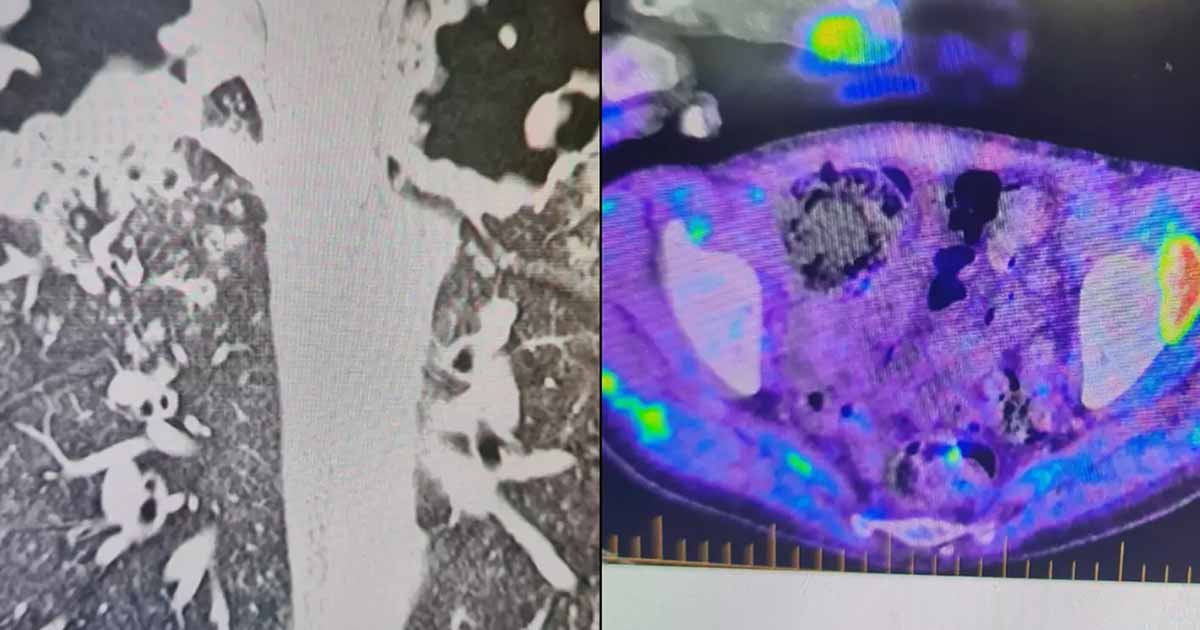 Man’s Lungs Deteriorating After Contracting Waterborne Illness From ...