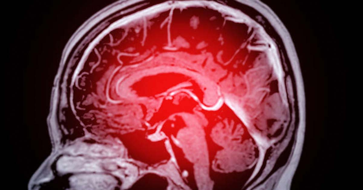 Frontotemporal Dementia: Types, Symptoms, Causes and More