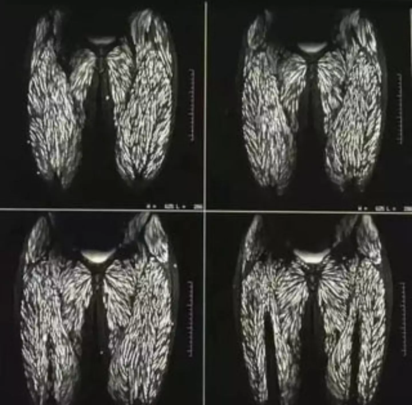 Scans Reveal Parasite-Infested Body of Woman Who Ate Large Amounts of ...