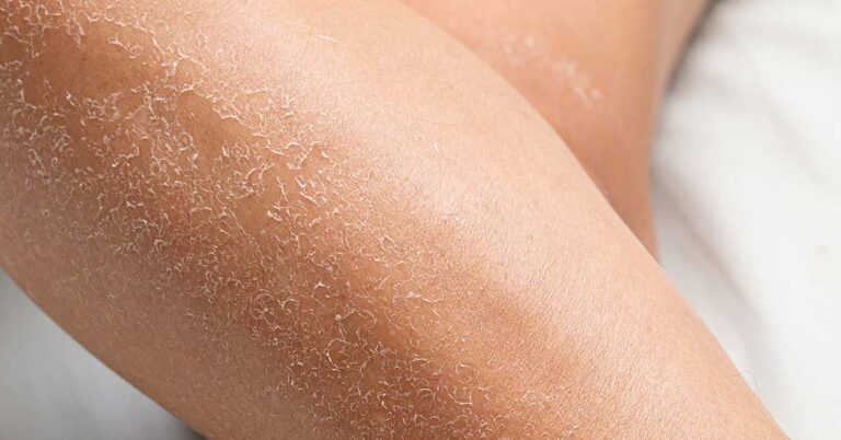 9 Natural Ways To Improve Dry Flaky Skin