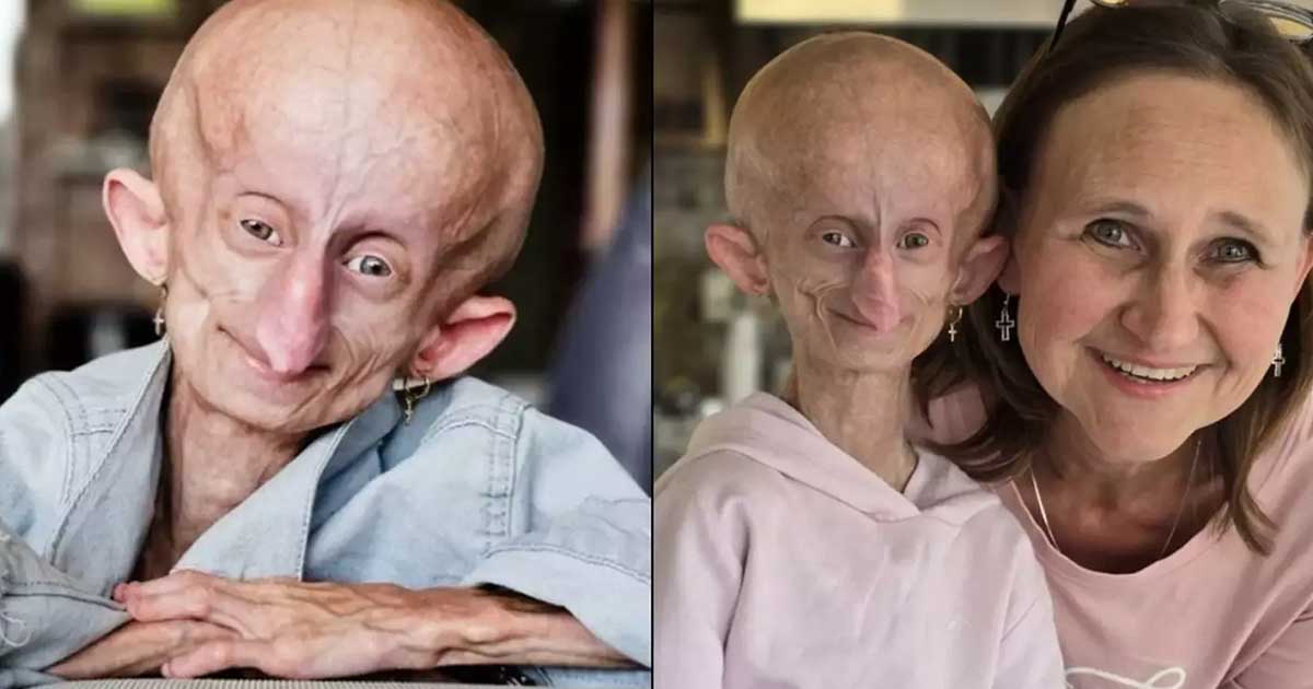 Teen Girl, With The ‘Body of a 152-year-old’, Dies at 19 Due to Rare Condition Known As Progeria