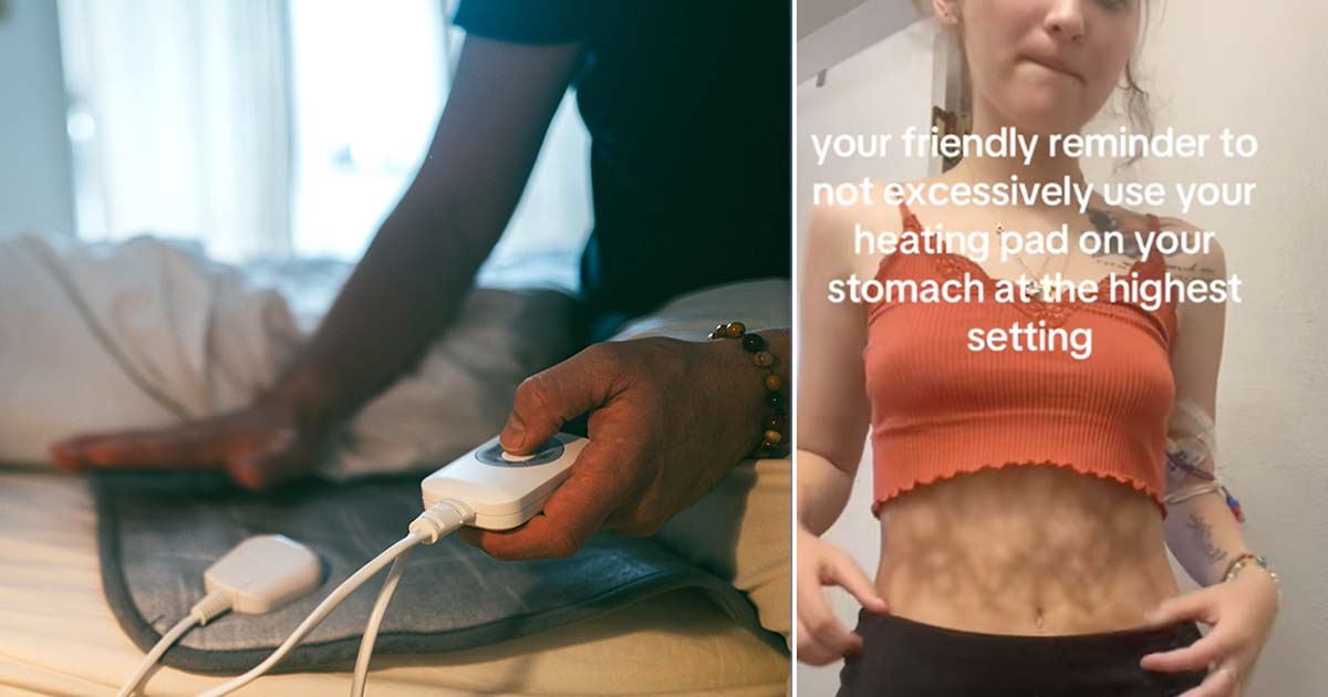 Heating Pads and Blankets Linked to 'Toasted Skin Syndrome,' Experts ...