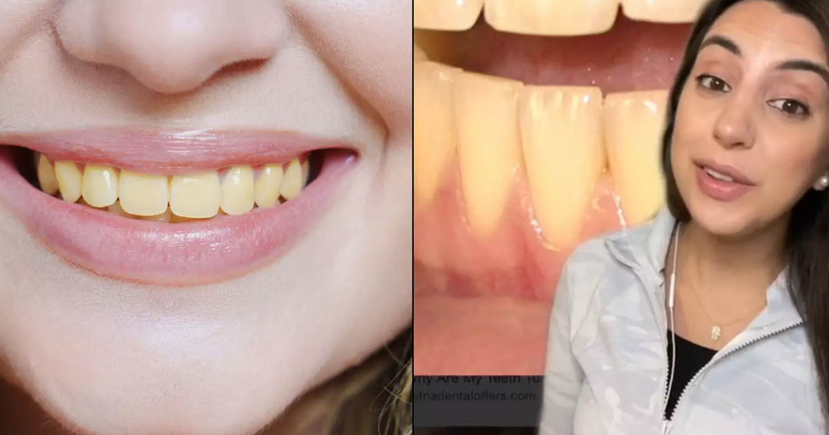 Why Your Teeth Are Yellow Even Though You Brush Them: Dentist