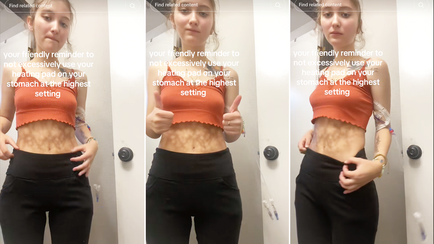 Heating Pads and Blankets Linked to 'Toasted Skin Syndrome,' Experts ...