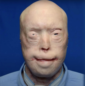 Patrick Hardison received a new face after third-degree burns, this is ...