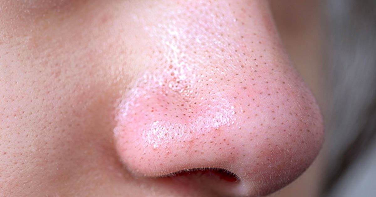 What Are Sebaceous Filaments and Why Are They on Your Face?