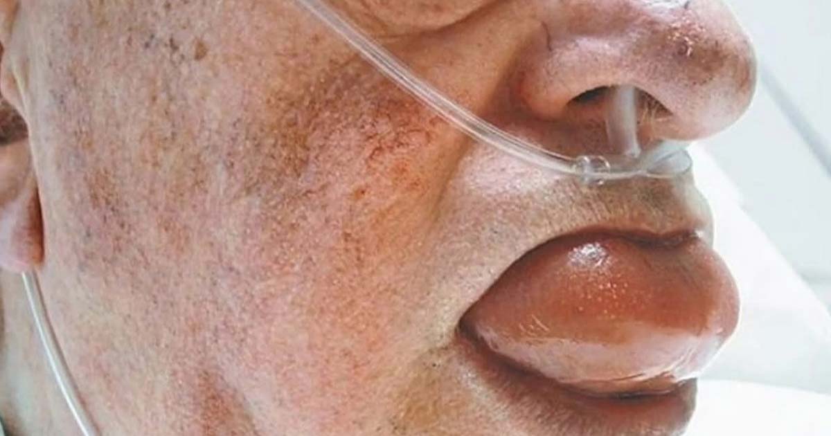Angioedema From Blood Pressure Drugs: What You Need to Know if You Take ...