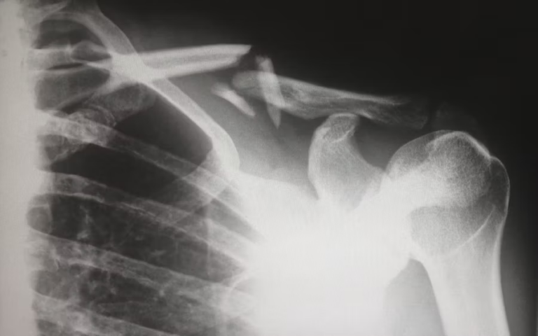If You’ve Never Broken a Bone There’s a Strange Conspiracy Theory You ...