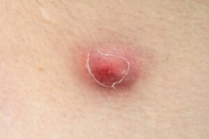 Common Habits That Can Cause Armpit Pimples, and What To Do About Them