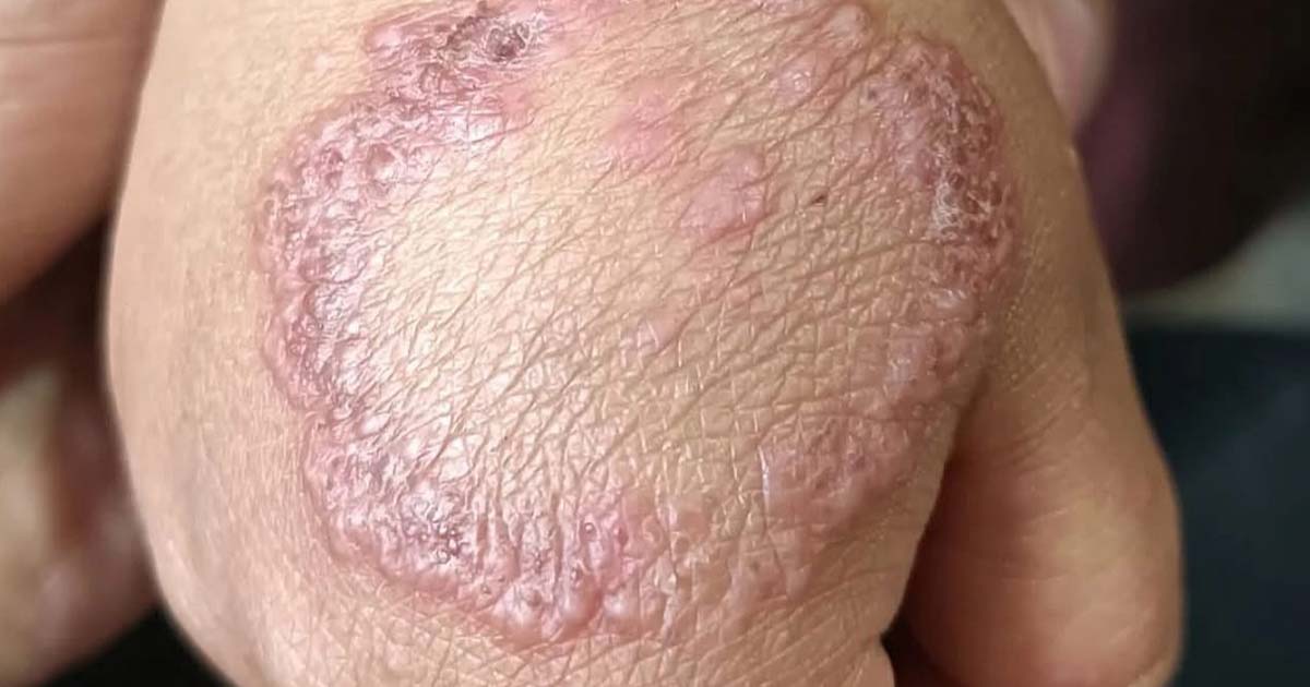 What Is Tinea Manuum? (Causes, Treatment, and More) : The Hearty Soul