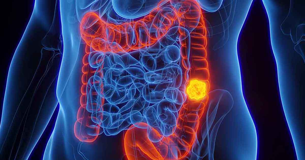 Exploring The Link Between Gut Bacteria and Colon Cancer Risk