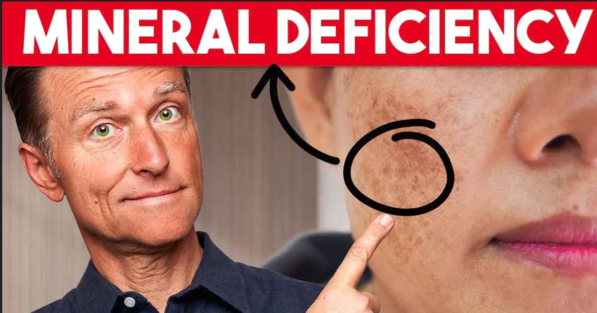How To Reduce Age Spots: Causes, Treatment, and Prevention : The Hearty ...