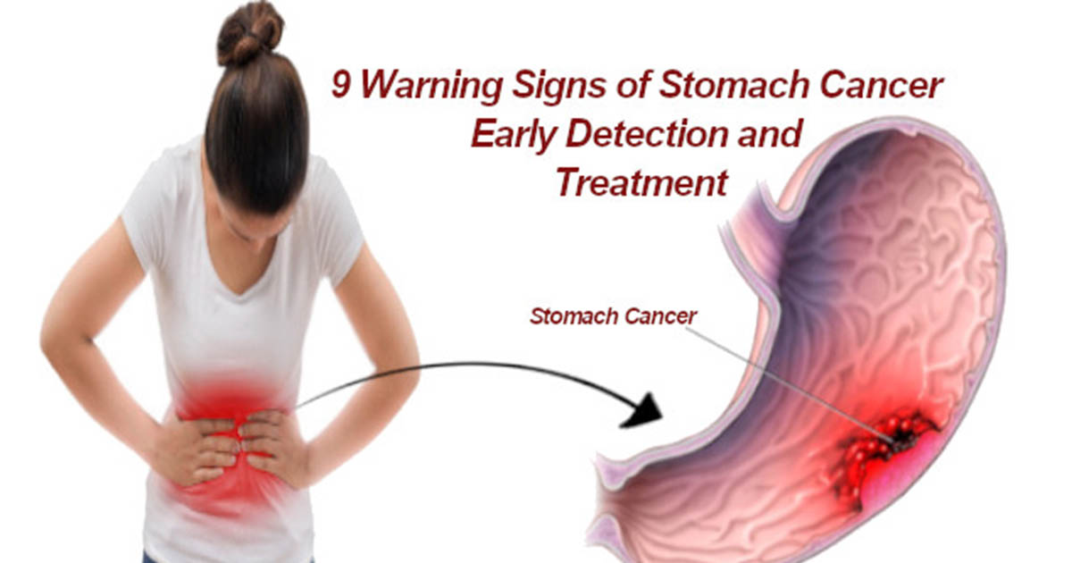 9 Crucial Signs of Stomach Cancer to Watch for and Treat Early : The ...