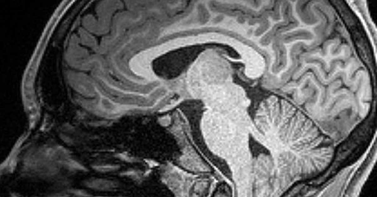 Researchers Identify New Subtypes of Common Brain Disorder : The Hearty ...