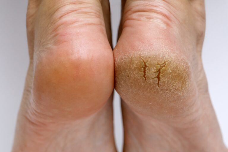 10 Symptoms of Diabetes That May Show Up In Your Feet