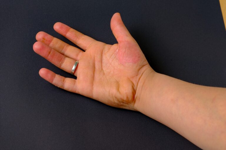 Paronychia: Exploring Its Causes, Recognizing the Symptoms, and Getting ...