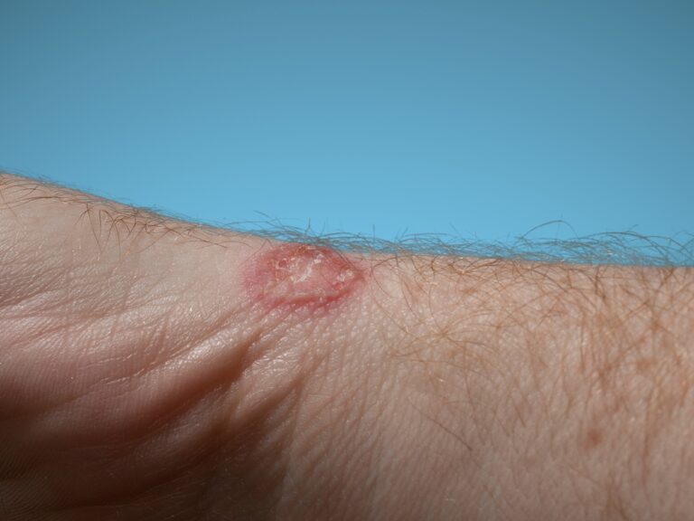 What Is Tinea Manuum? (Causes, Treatment, and More) : The Hearty Soul