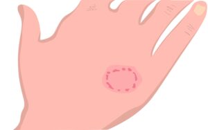 What Is Tinea Manuum? (Causes, Treatment, and More) : The Hearty Soul