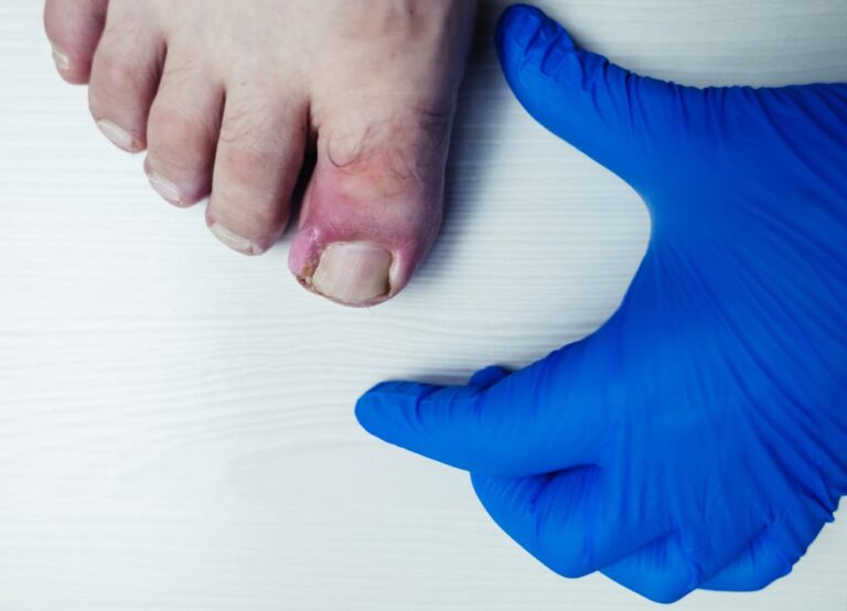 Paronychia: Exploring Its Causes, Recognizing the Symptoms, and Getting ...