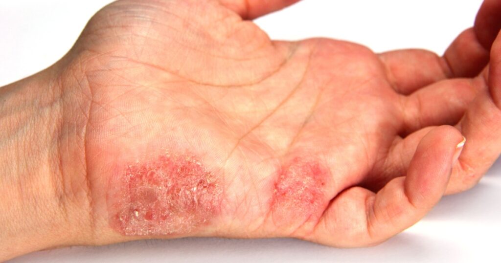 What Is Tinea Manuum? (Causes, Treatment, and More)