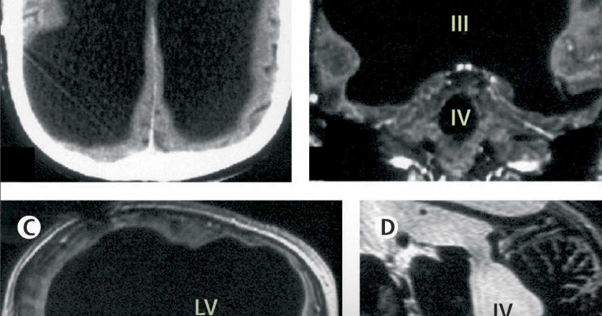 Medical miracle: Man With 90% of His Brain Damaged Defies Expectations ...