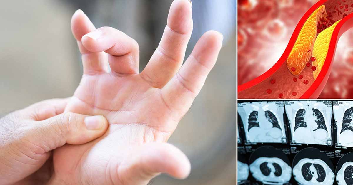 Xanthomas: Subtle Change to Your Hands May Be an Indication of High ...