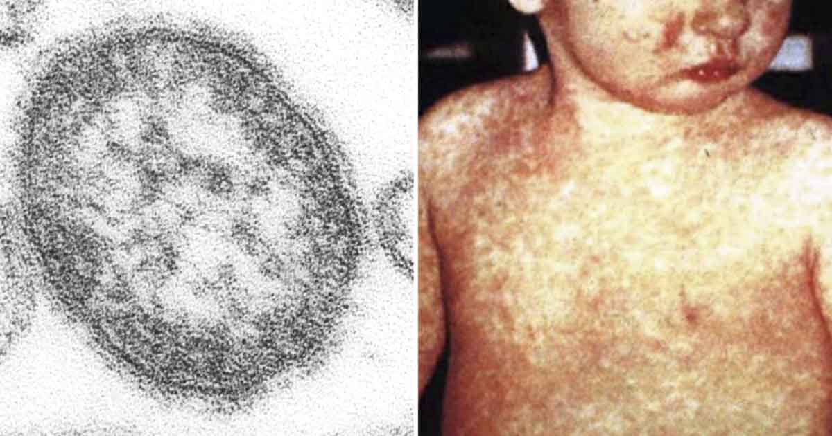 This is What Measles Does to Your Body : The Hearty Soul