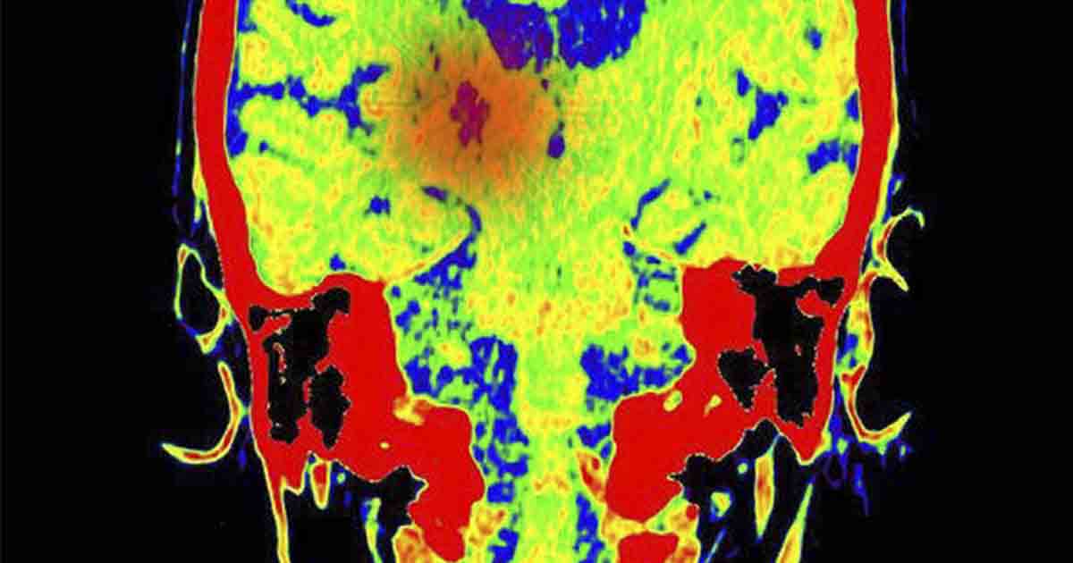 The 'Simple' Weekly Habit That Can Slow Brain Aging and Reduce Dementia ...