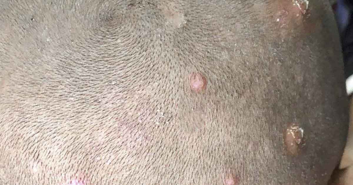 9 Possible Causes of Scalp Bumps (And When to Worry)