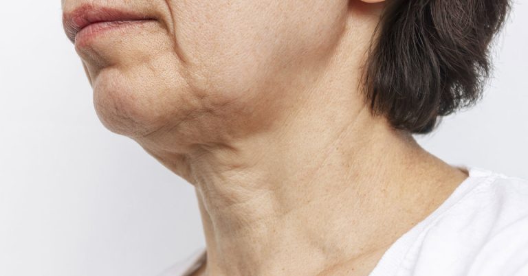 Sagging Neck Skin (Turkey Neck): Why It Happens And What To Do