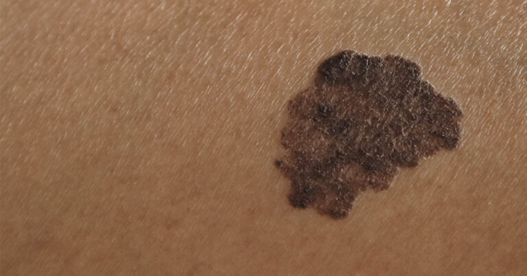 Rare But Deadly Skin Cancers That People Often Overlook : The Hearty Soul