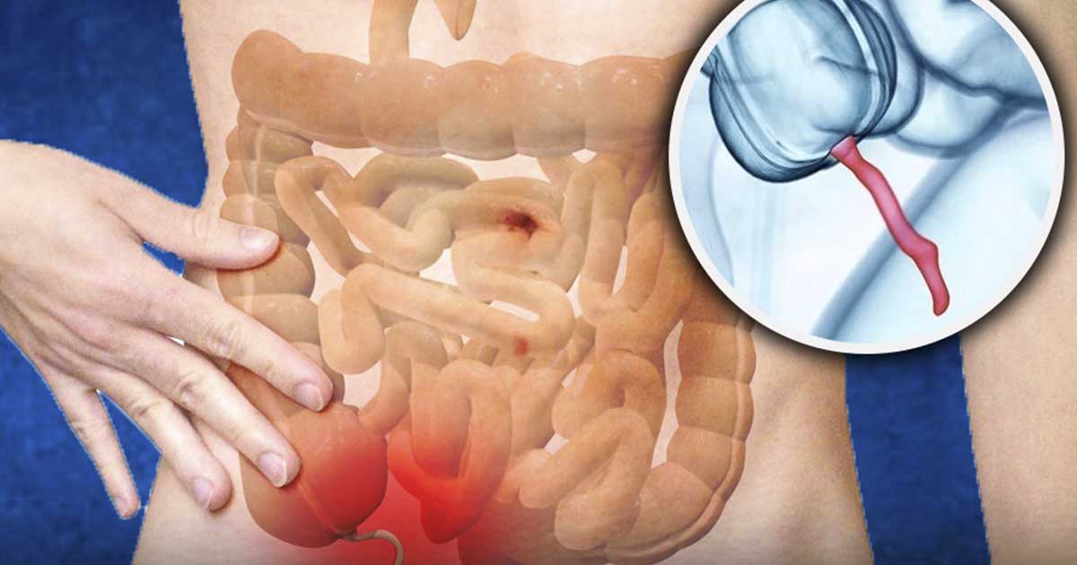 Why Your Appendix Might Be More Useful Than You Think