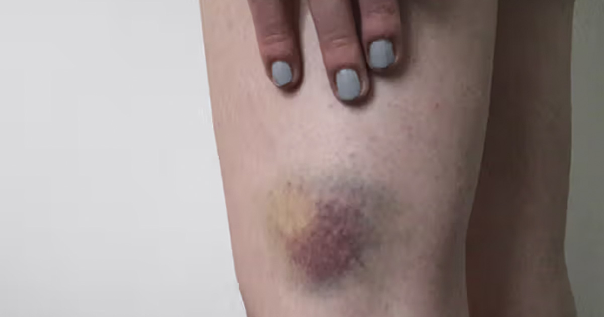 Why So Many Women Wake Up With Bruises They Don’t Remember Getting